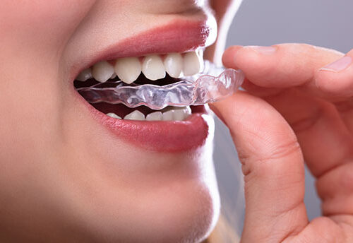 Invisalign Express - The 12th Precinct Orthodotics