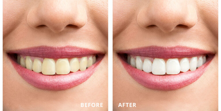 Teeth Whitening - The 12th Precinct Orthodotics