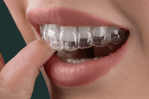 Invisalign for Adults - The 12th Precinct Orthodotics