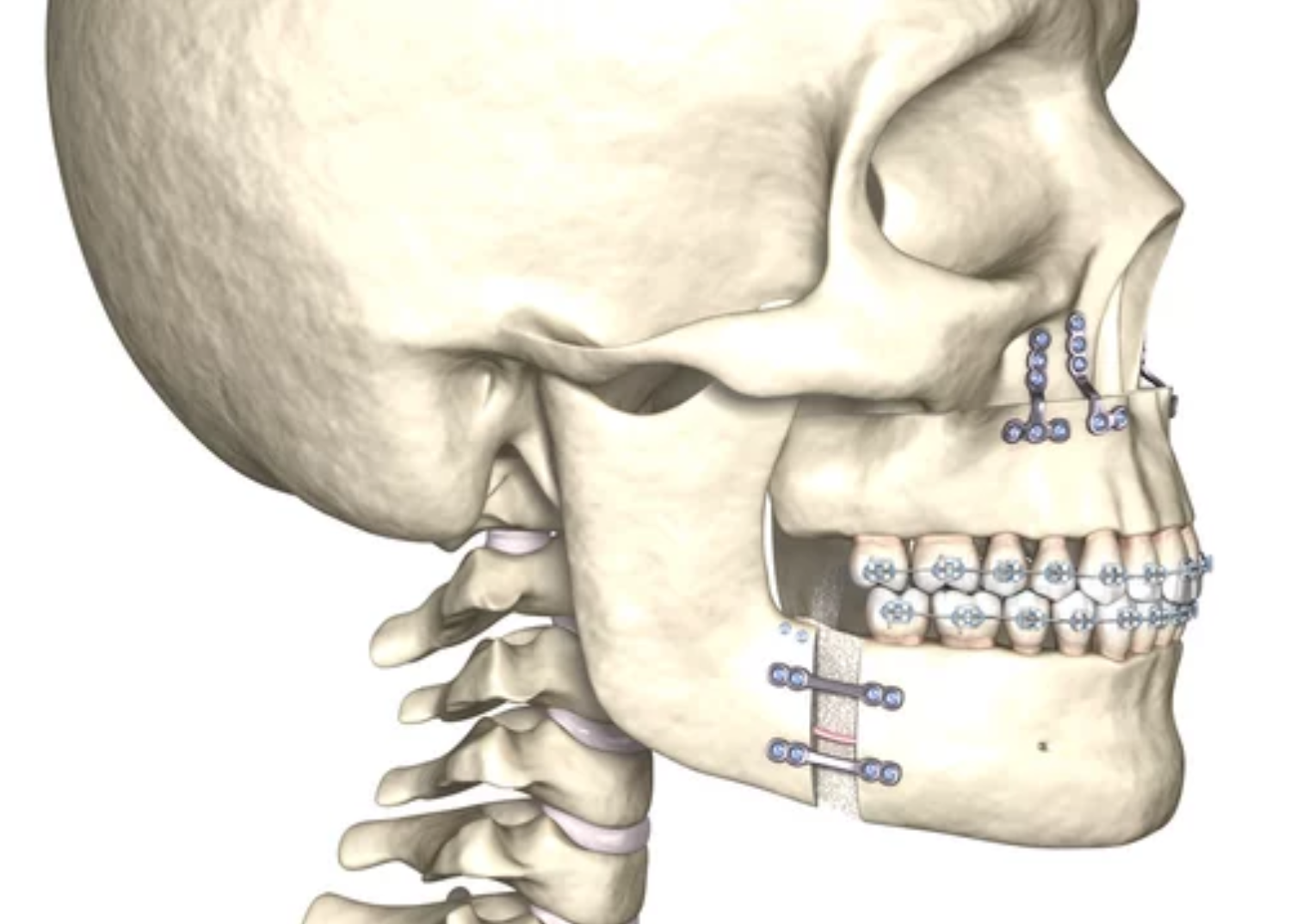 Jaw Surgery - The 12th Precinct Orthodotics
