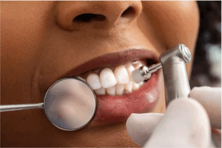 Full Mouth Scaling And Polishing - The 12th Precinct Orthodotics