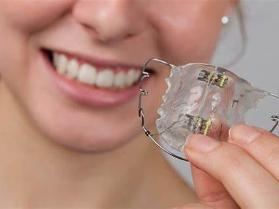 Types of Braces - The 12th Precinct Orthodotics